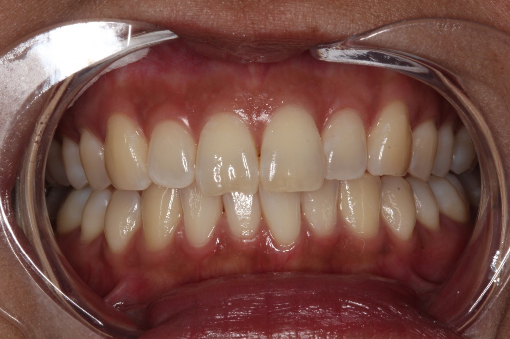Before and After - Chipped Front Tooth - Autumn Lake Dental Blog
