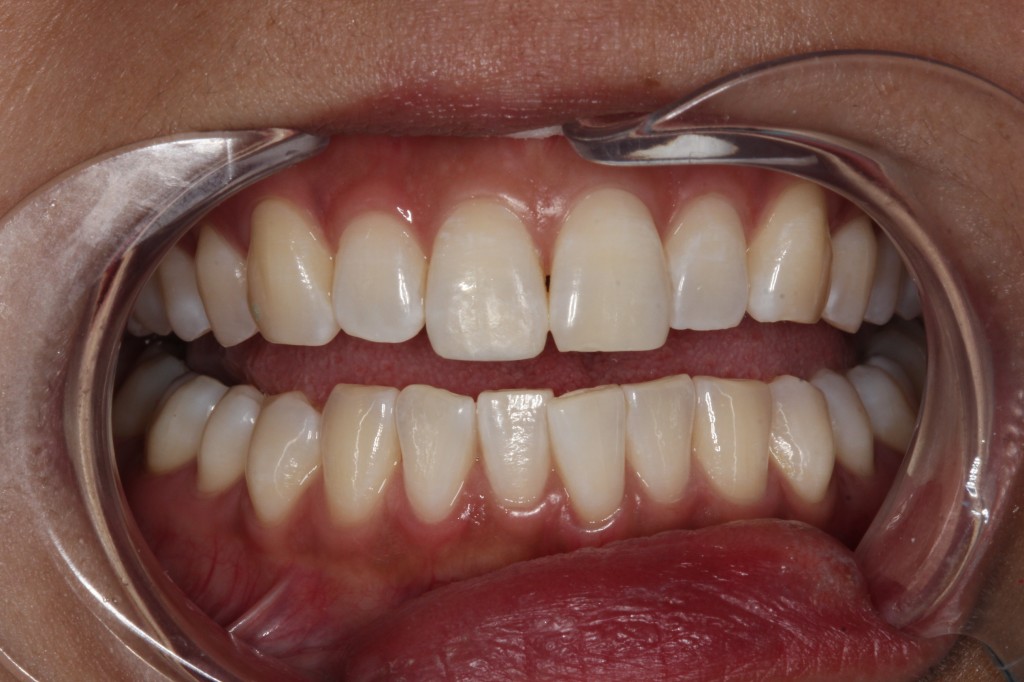 Before and After - Chipped Front Tooth - Autumn Lake Dental Blog